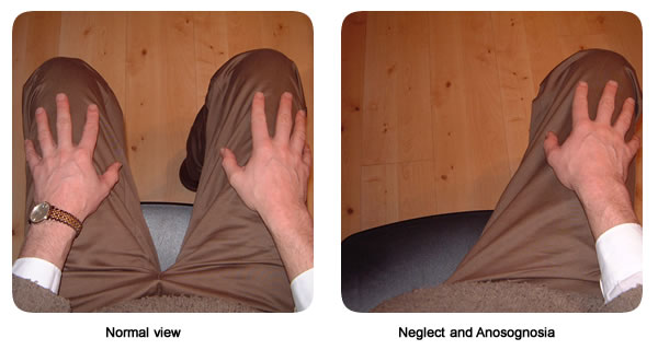 Spontaneous Speech Look Left The Basics Of Hemispatial Neglect Part 